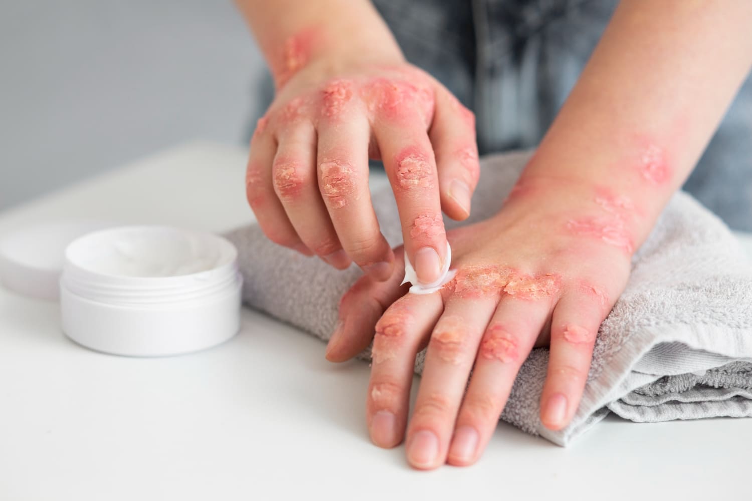 Dover Psoriasis and Psoriatic Arthritis Treatment & Care