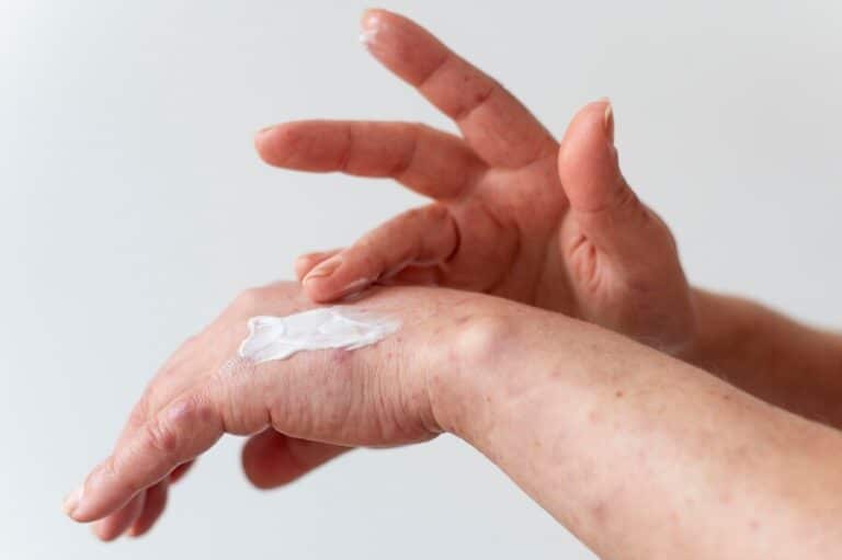 Psoriasis and Psoriatic Arthritis: Key Facts and Treatments